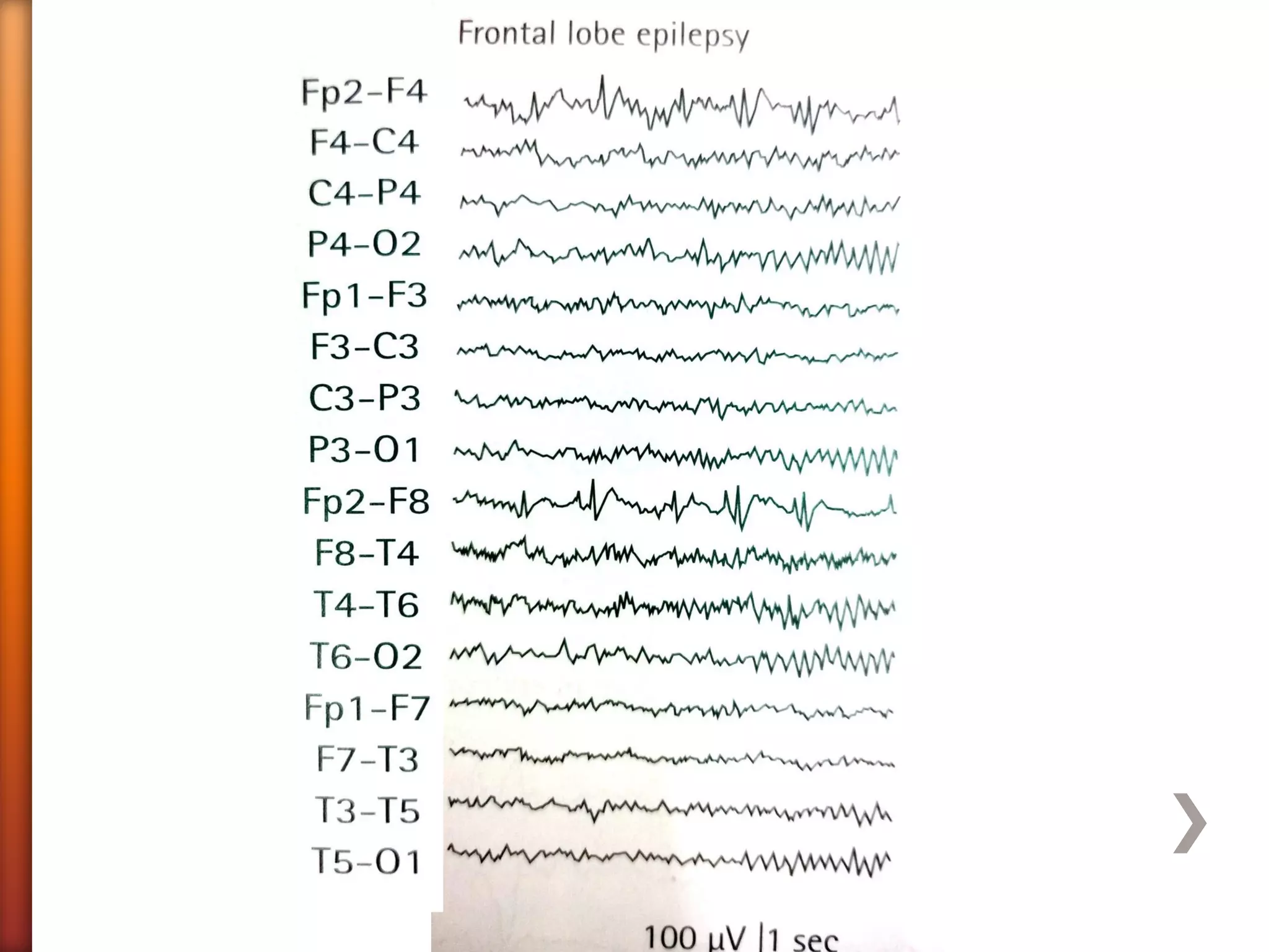 Frontal lobe epilepsy | PDF
