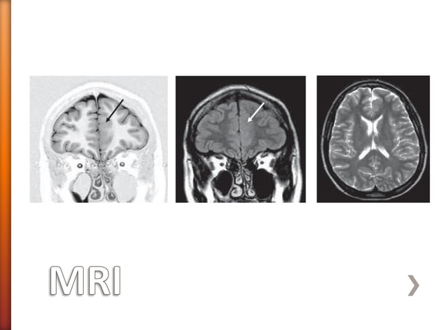 Frontal lobe epilepsy | PDF