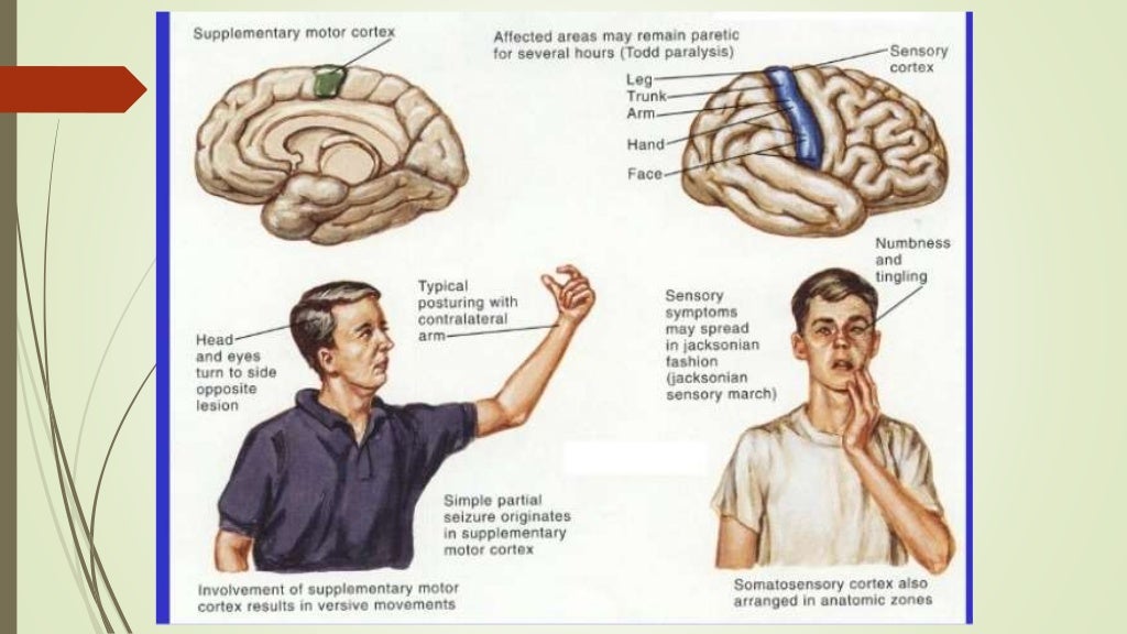 Frontal Lobe Epilepsy