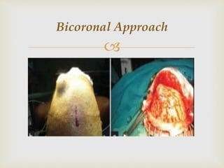 Frontal osteoma - HARSH AMIN | PPTX