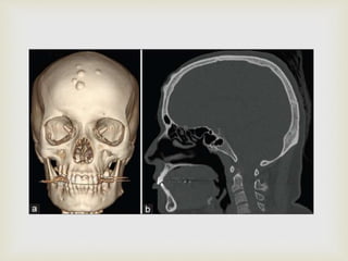 Frontal osteoma - HARSH AMIN | PPTX
