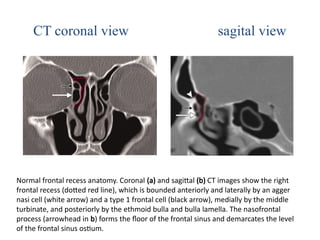 Approach to frontal sinus. Presentation. | PPTX