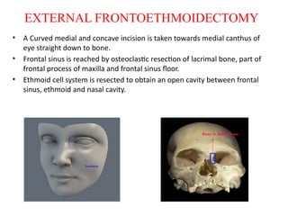 Approach to frontal sinus. Presentation. | PPTX