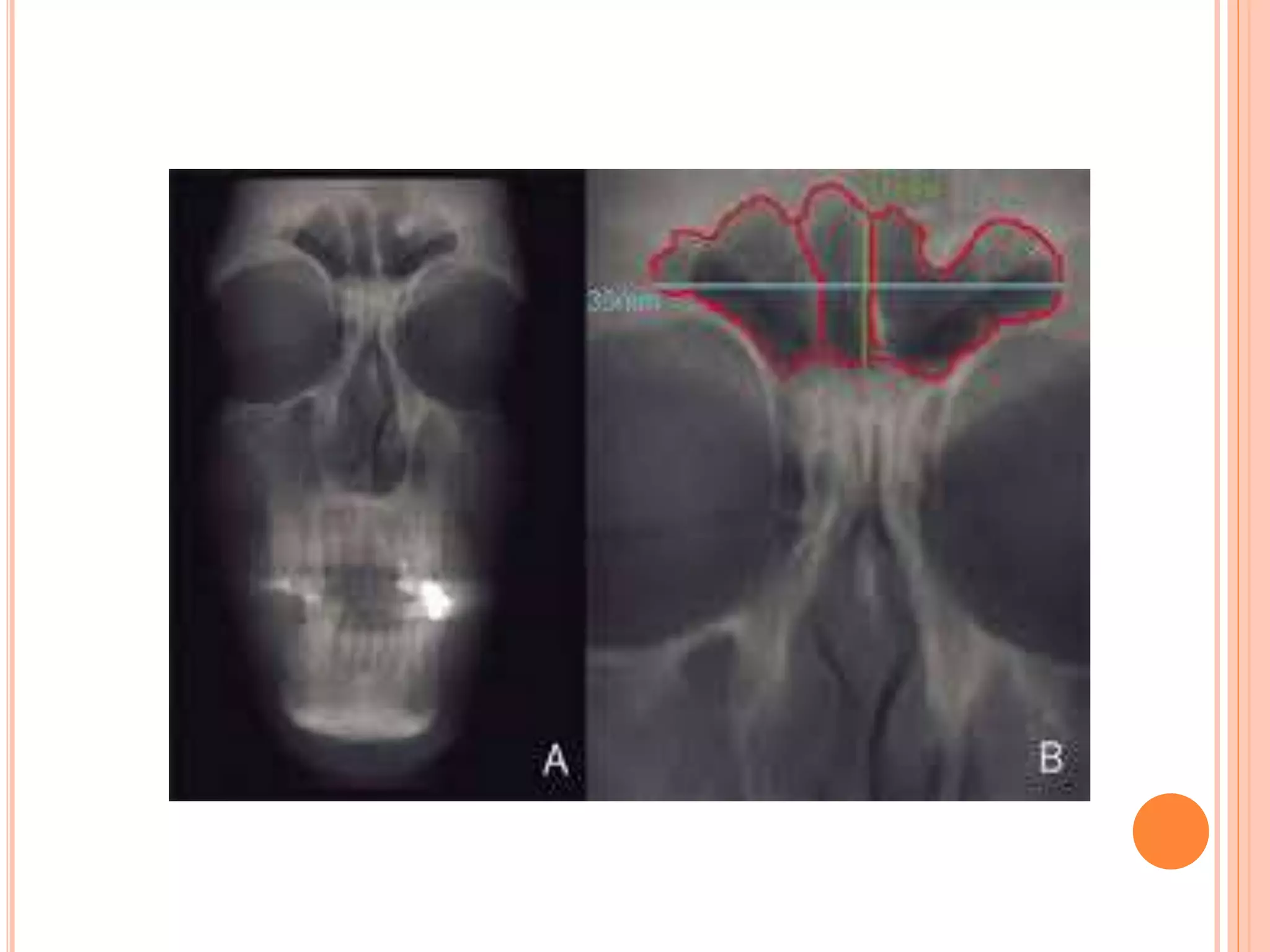 Frontal sinus as a tool in identification | PPT