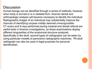 Frontal sinus as a tool in identification | PPT