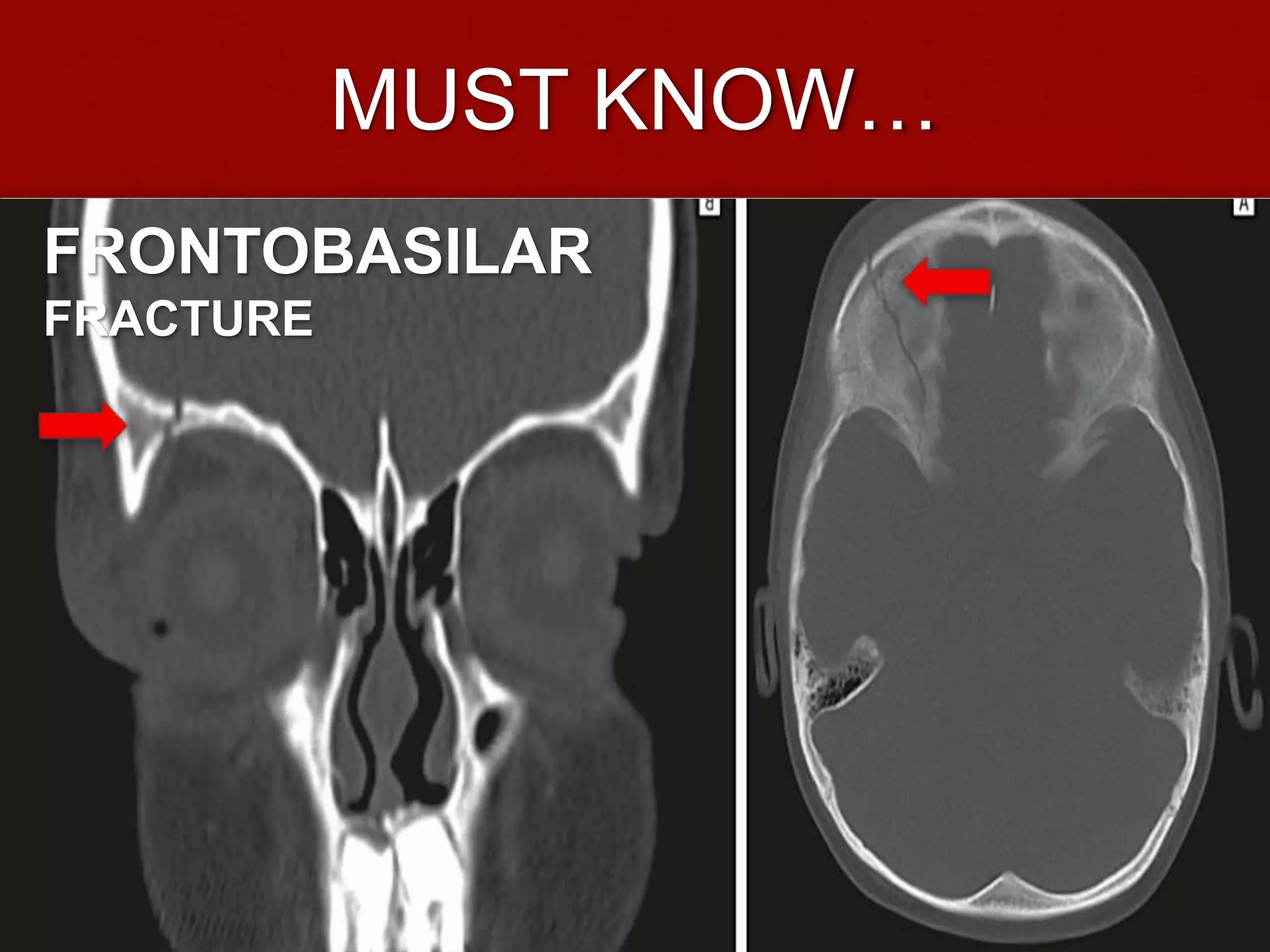 Frontal Sinus fracture management | PPTX