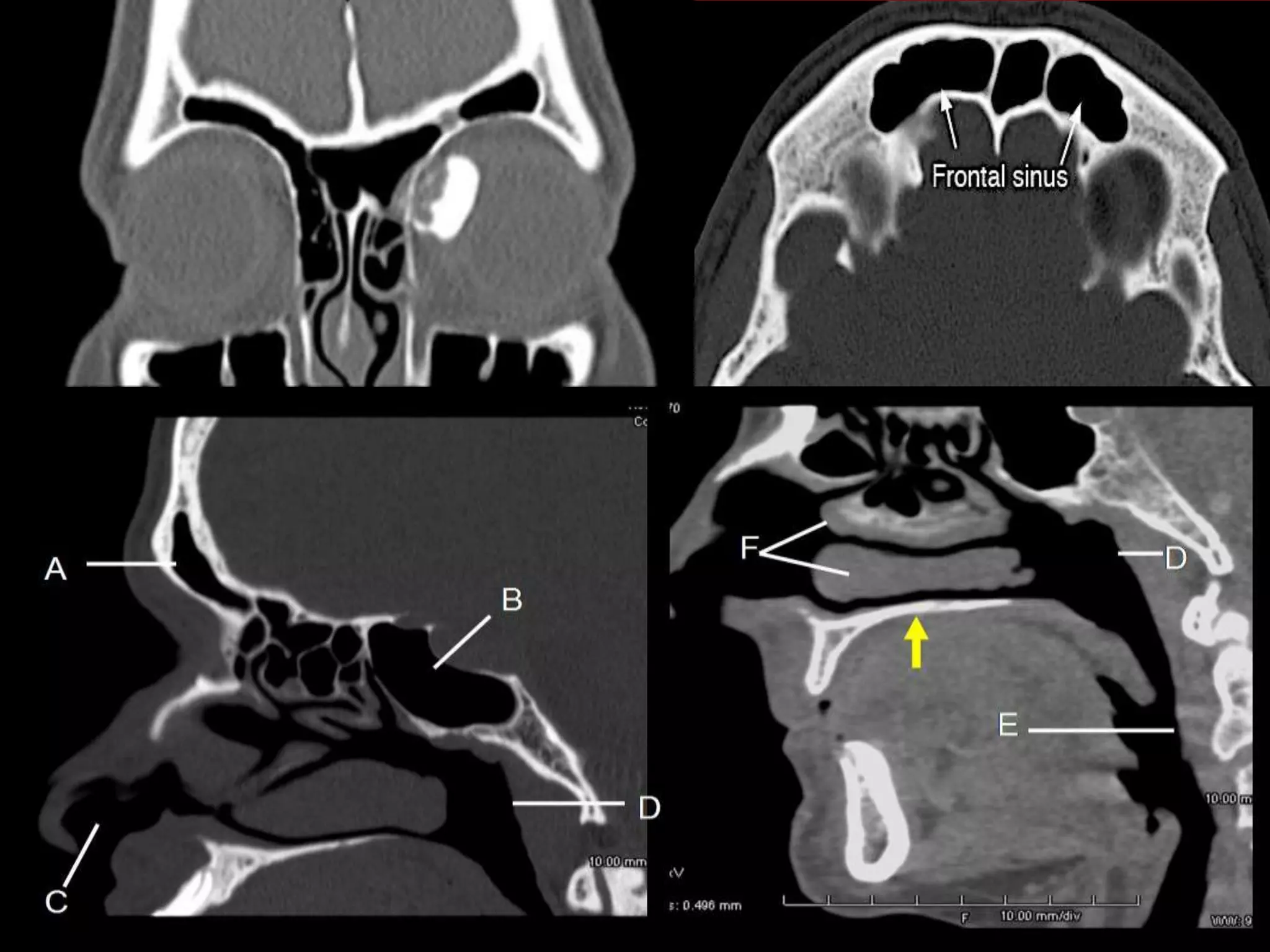 Frontal Sinus fracture management
