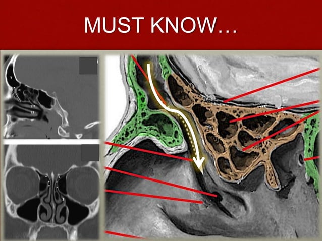 Frontal Sinus fracture management