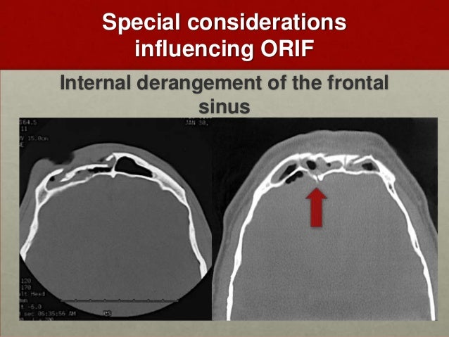Frontal Sinus fracture management