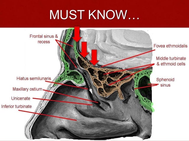 Frontal Sinus fracture management