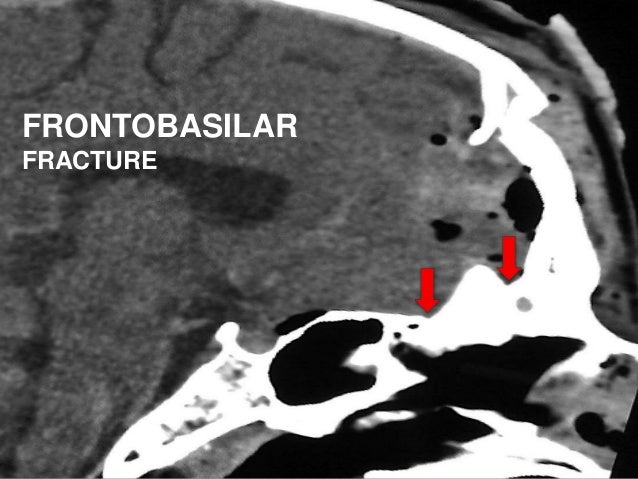 Frontal Sinus fracture management