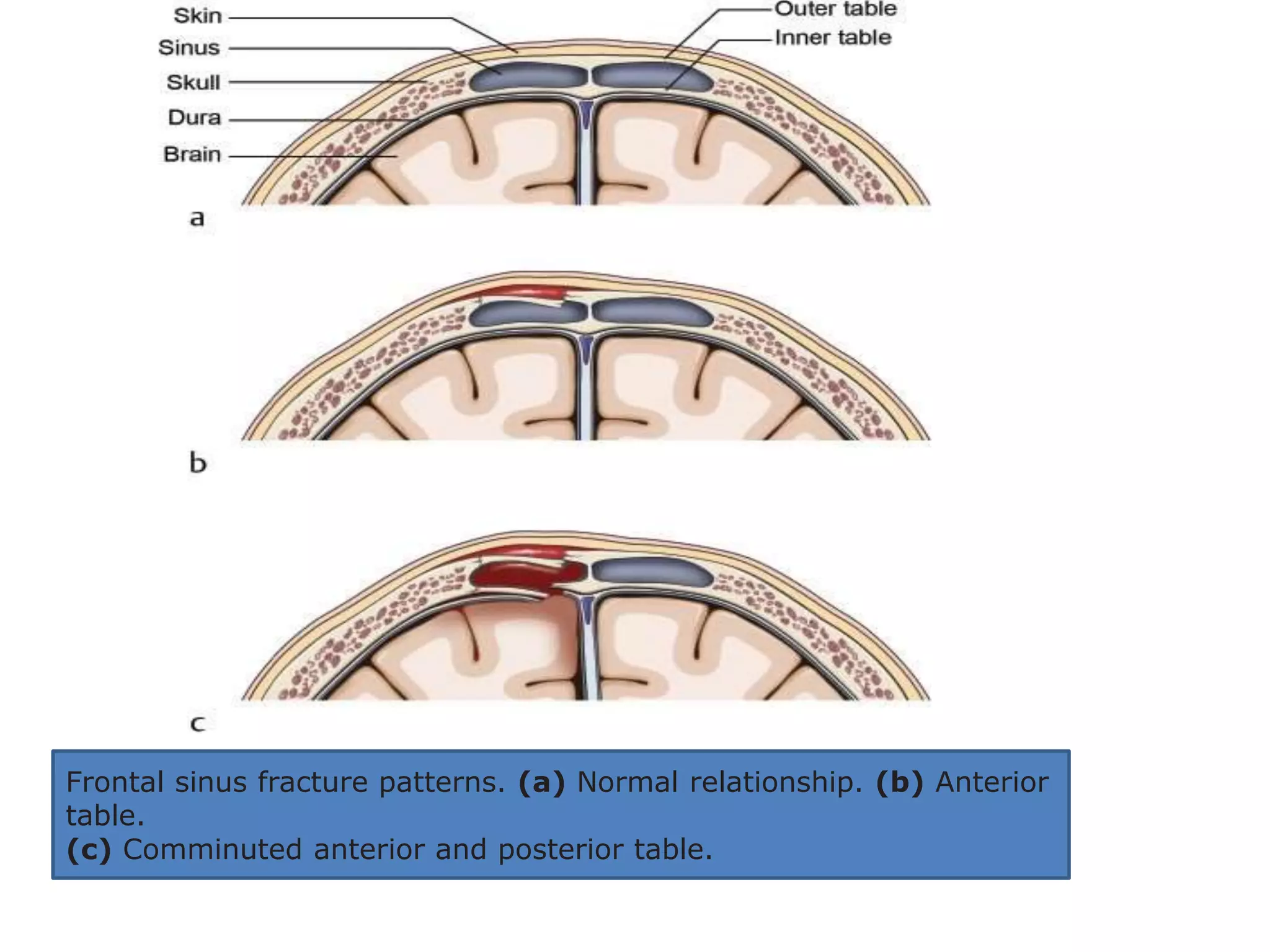Frontal sinus fracture | PPTX