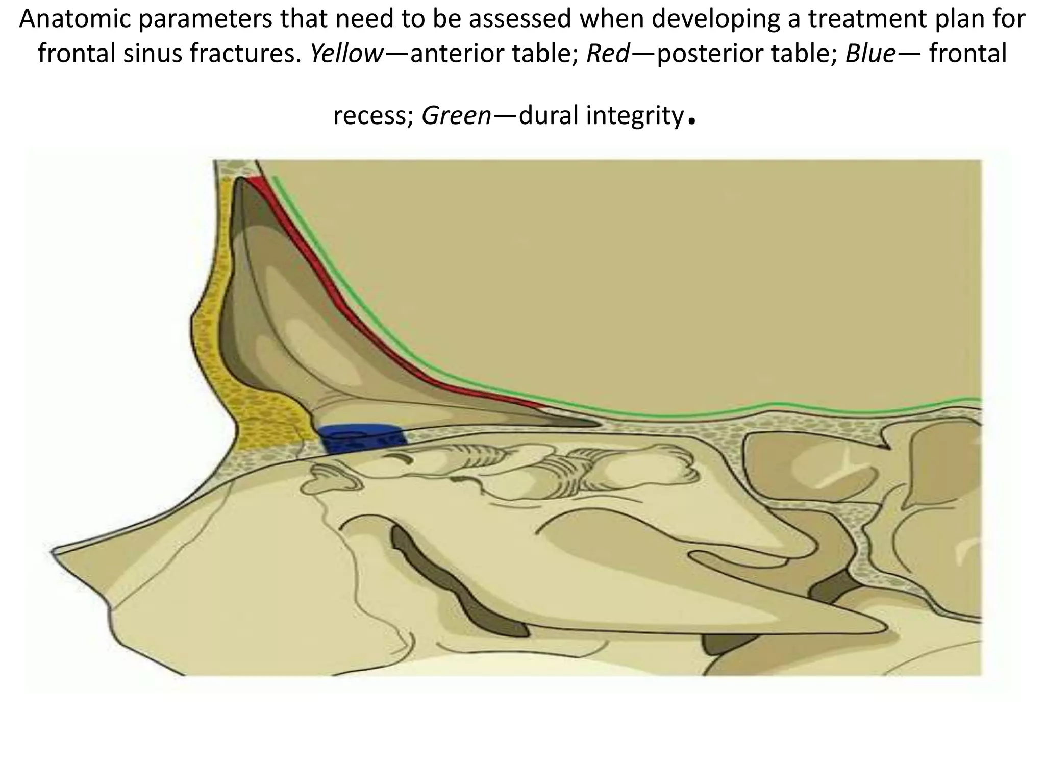 Frontal sinus fracture | PPTX