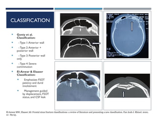 Frontal_Sinus_Fracture_Case_Series_Presentation.pptx