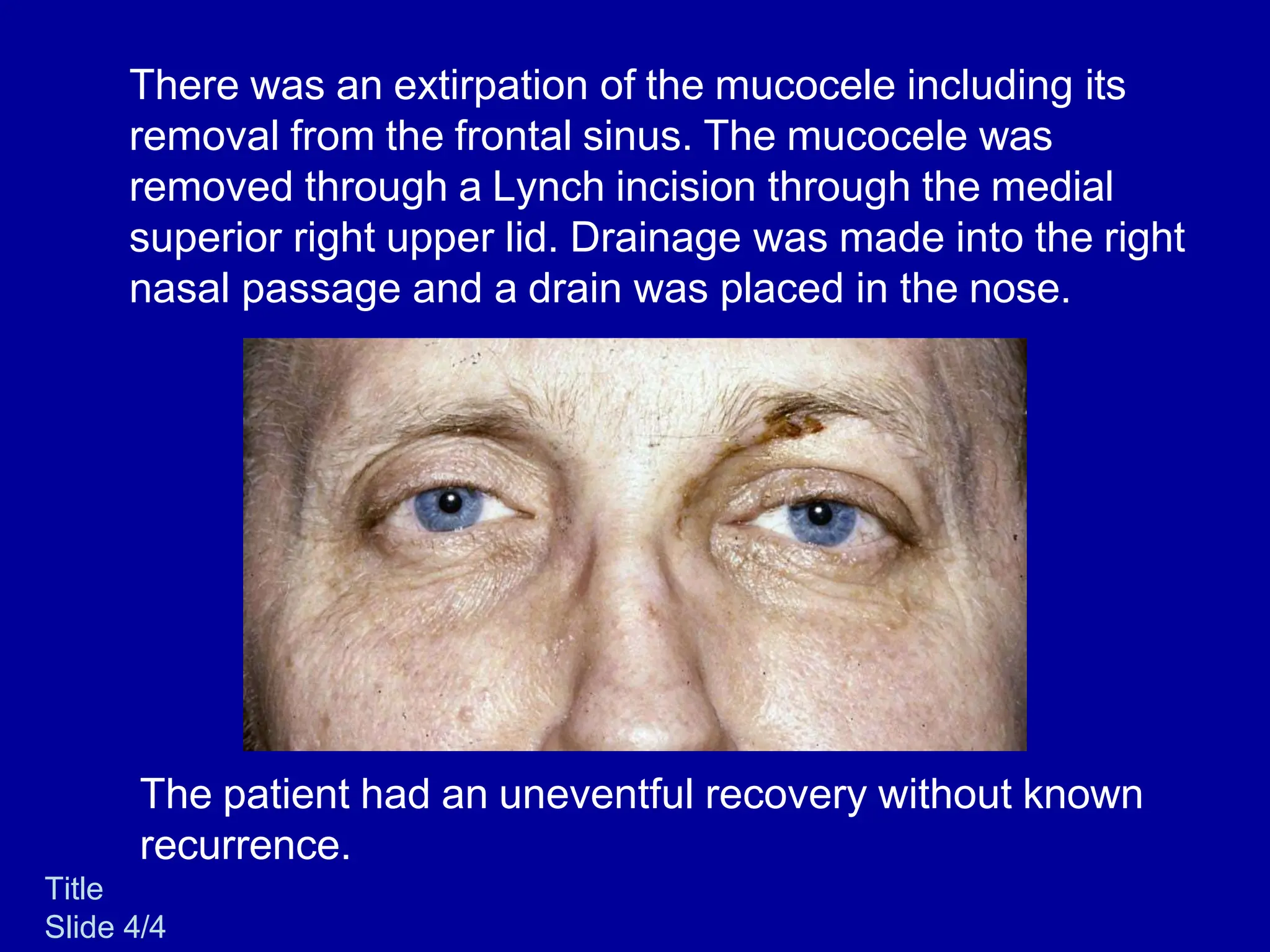 Frontal_Sinus_Mucocele_Kennerdell_Case_51_PPT_.pptx