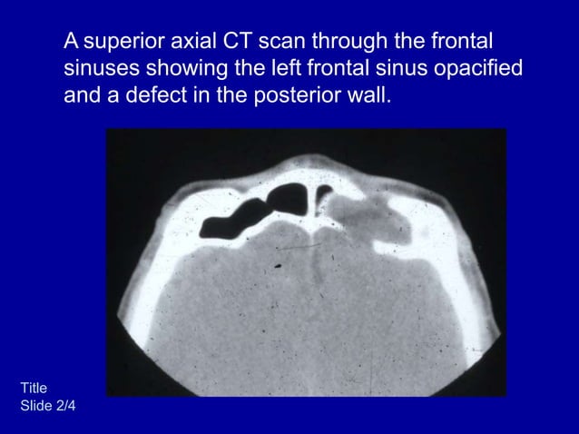 Frontal_Sinus_Mucocele_Kennerdell_Case_51_PPT_.pptx | Ear, Nose and Throat Conditions | Diseases ...