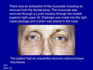 Frontal_Sinus_Mucocele_Kennerdell_Case_51_PPT_.pptx