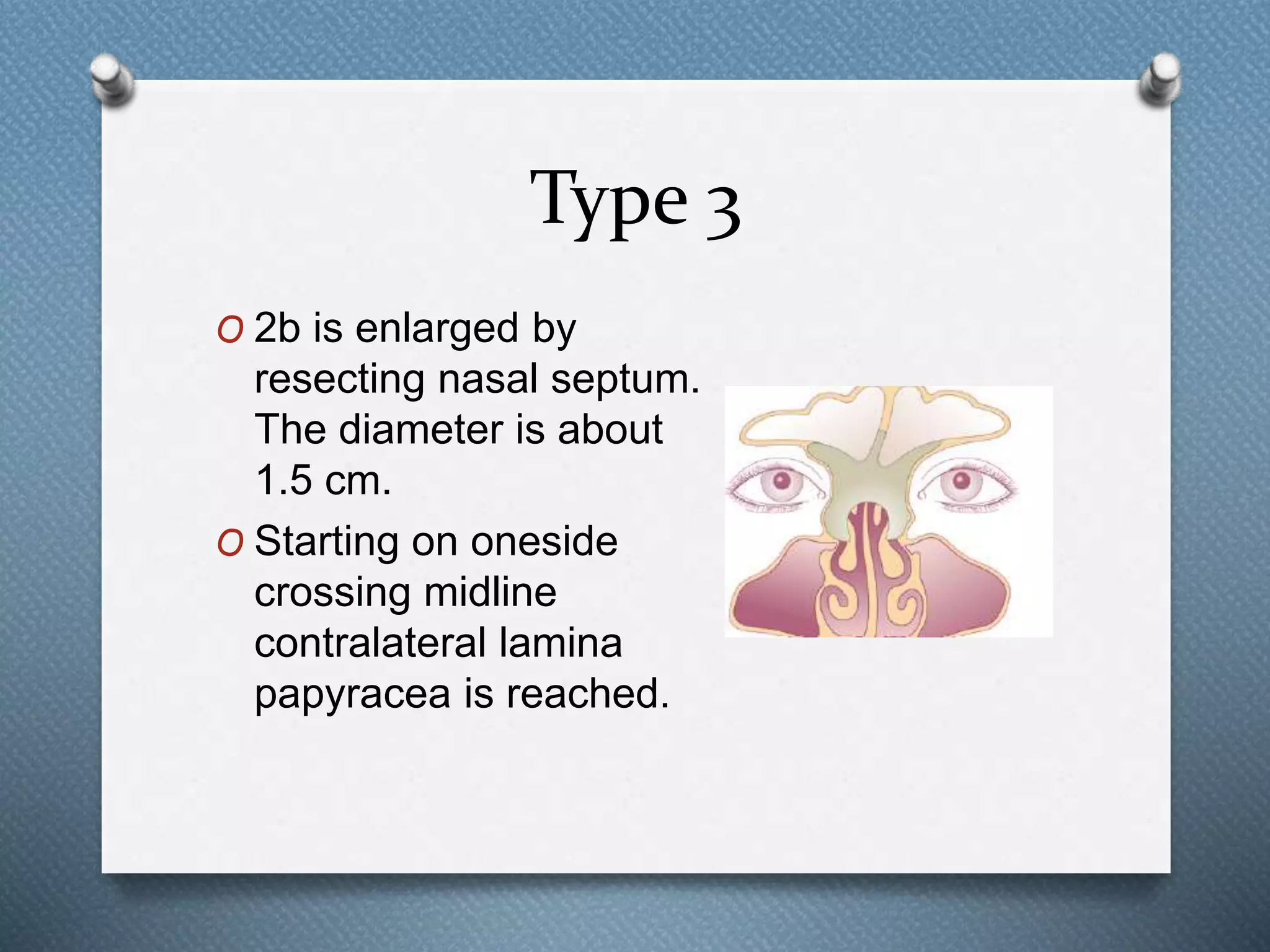 Frontal sinus procedures | PPTX