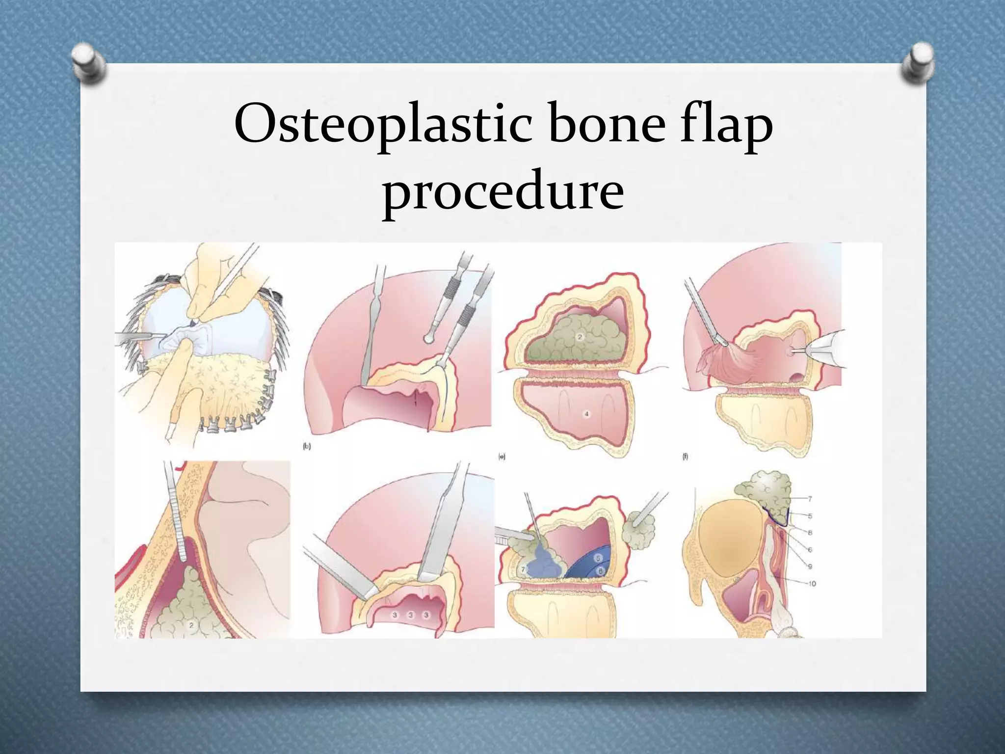 Frontal sinus procedures | PPTX