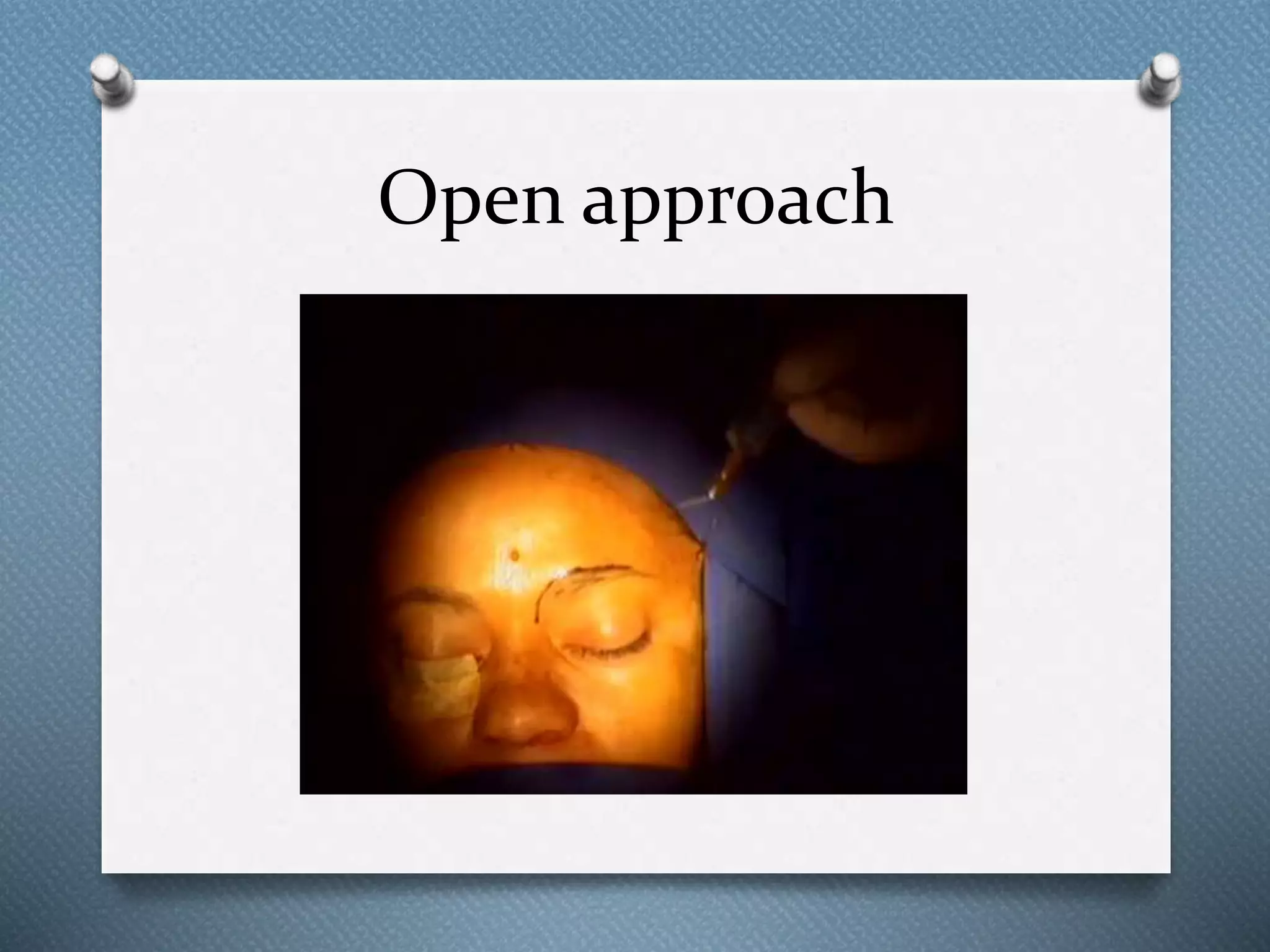Frontal sinus procedures | PPTX