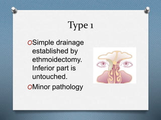 Frontal sinus procedures | PPTX