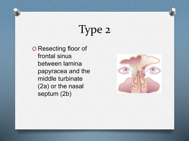 Frontal sinus procedures | PPTX