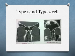 Frontal sinus procedures | PPTX