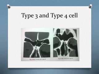 Frontal sinus procedures | PPTX