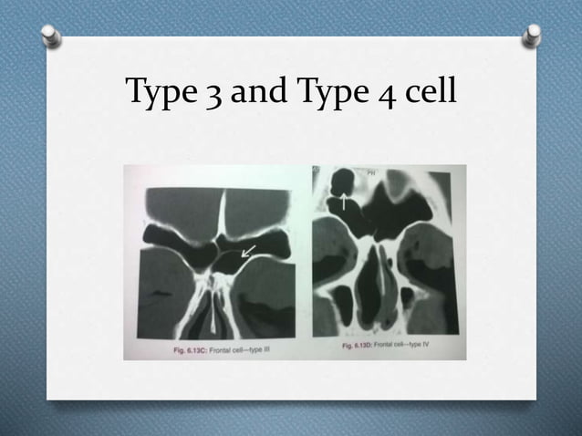 Frontal sinus procedures | PPTX