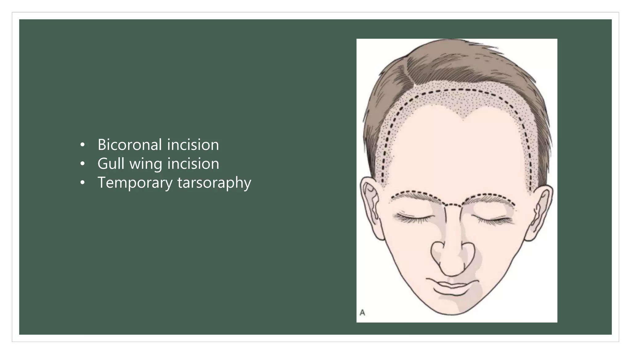 Frontal sinus surgeries | PPTX