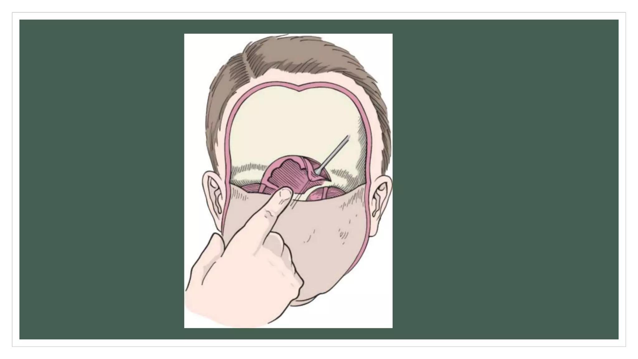 Frontal sinus surgeries | PPTX
