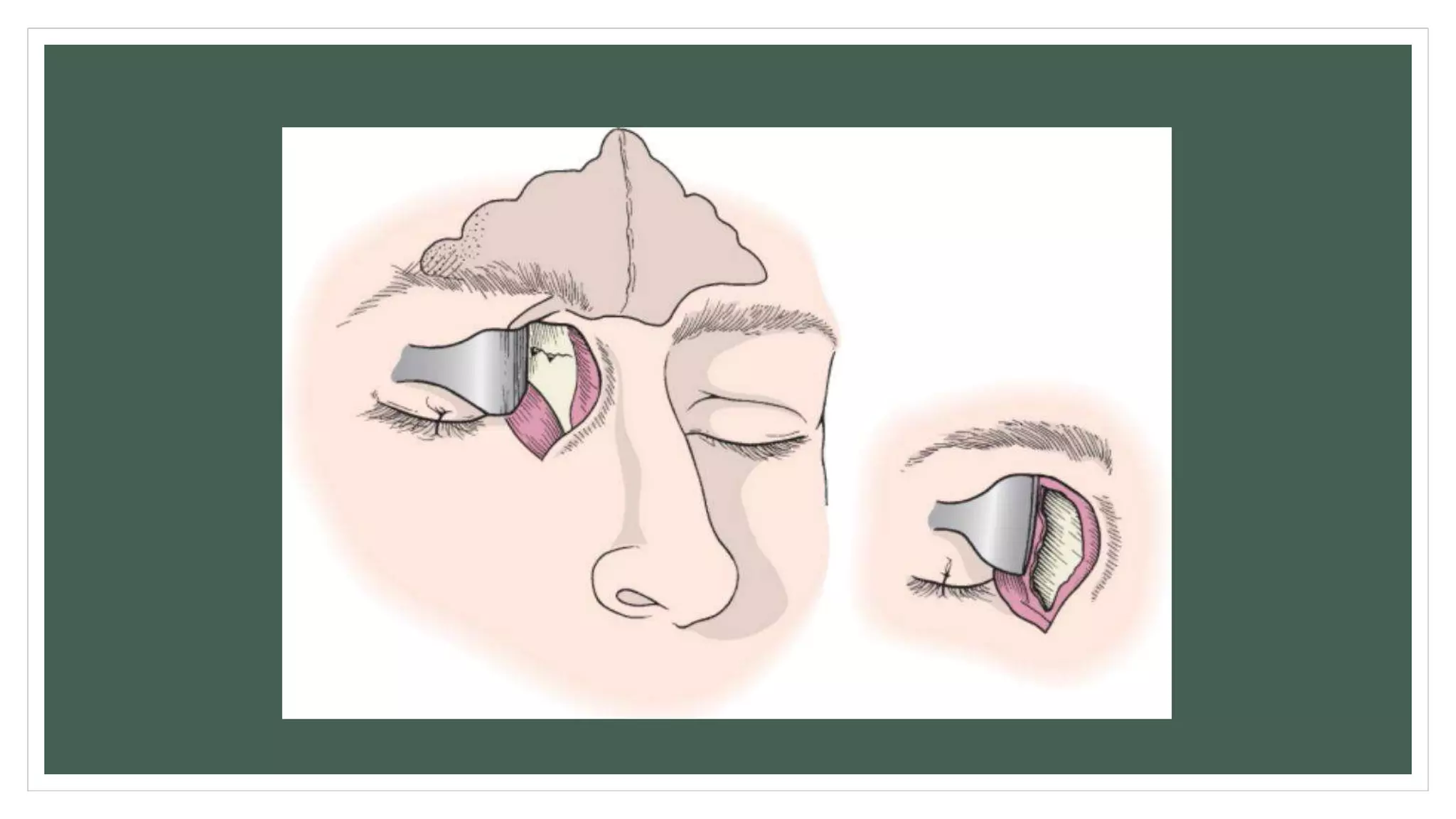 Frontal sinus surgeries | PPTX