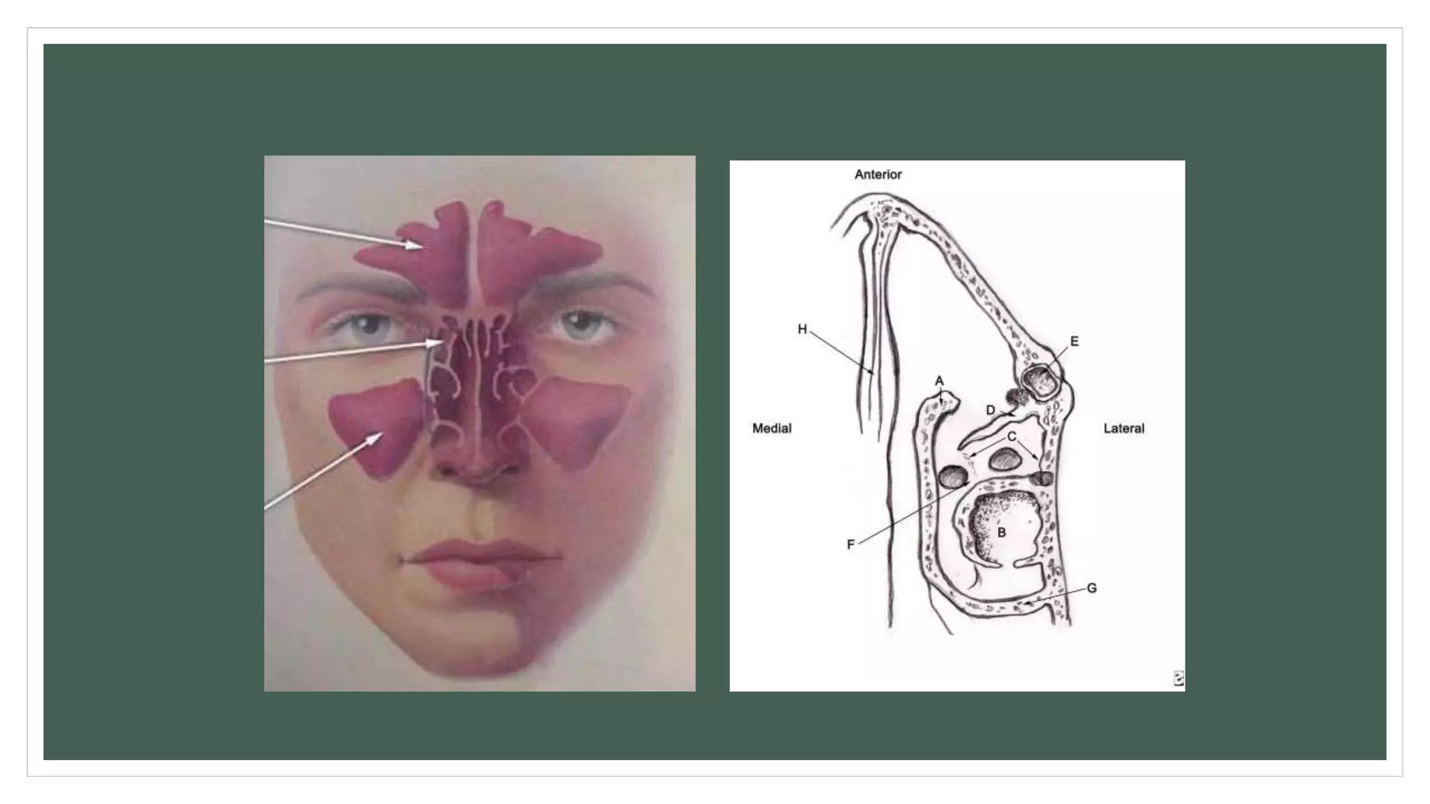 Frontal sinus surgeries | PPTX