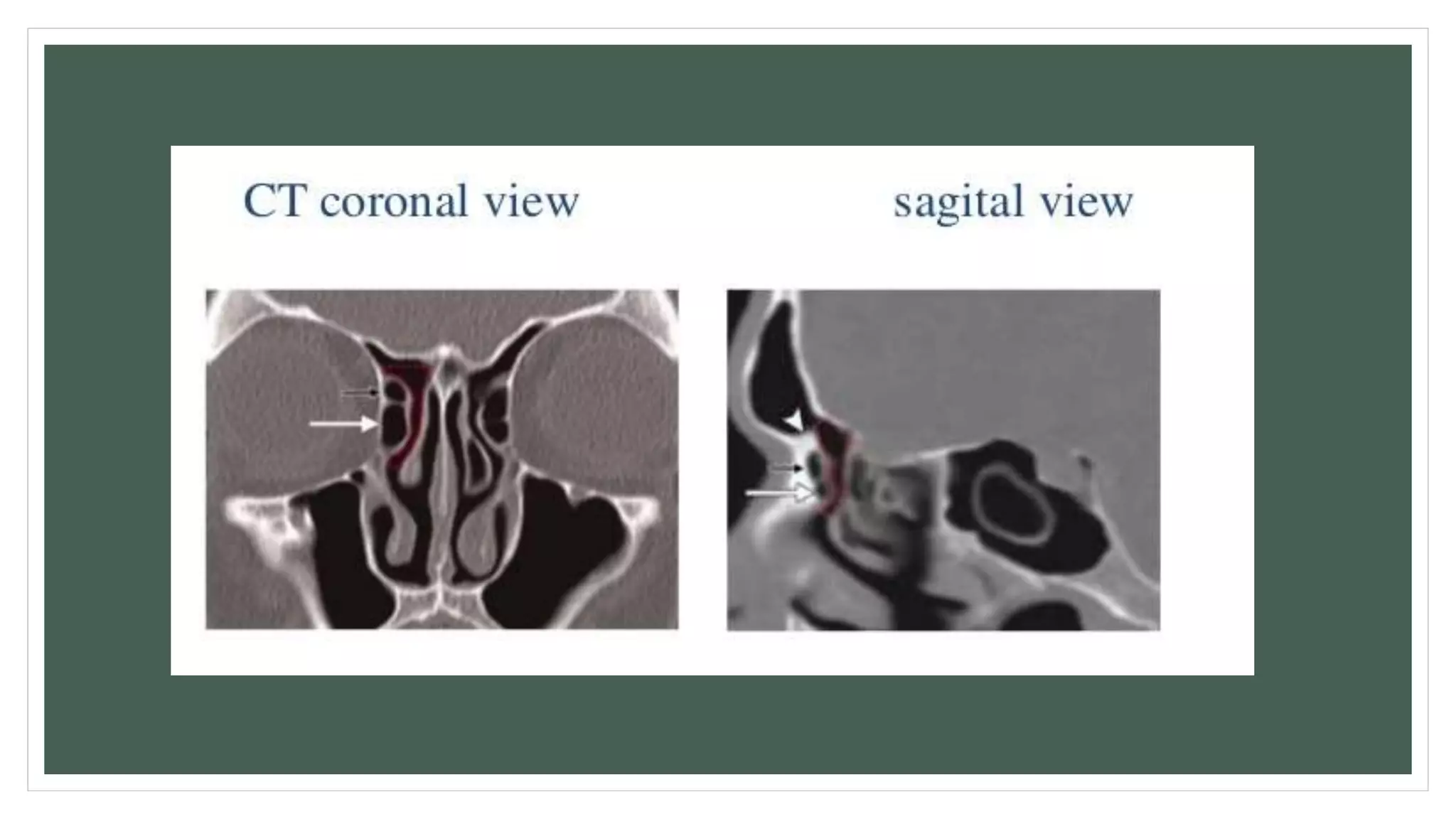 Frontal sinus surgeries | PPTX