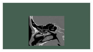 Frontal sinus surgeries | PPTX