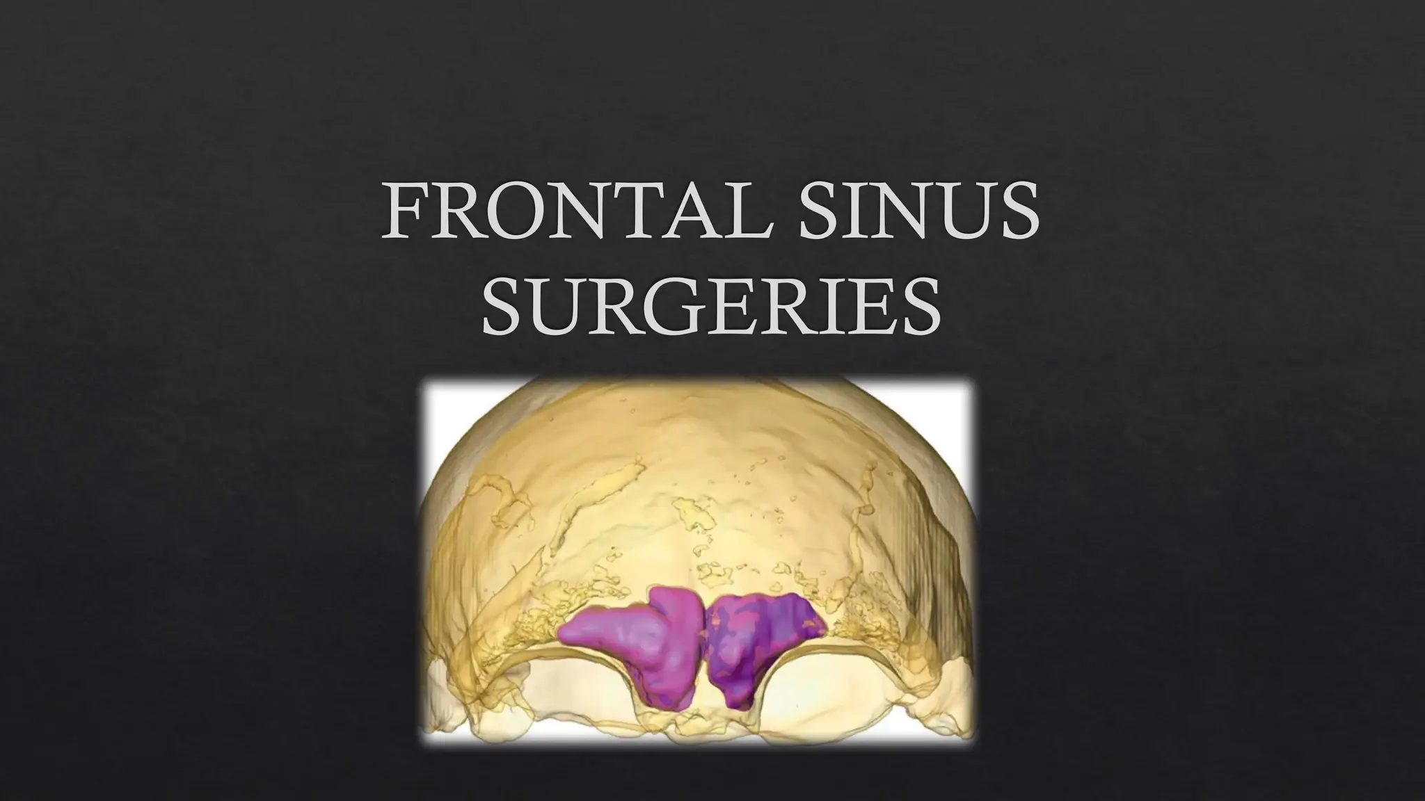 FRONTAL SINUS SURGERIES- DRAF procedures | PPTX