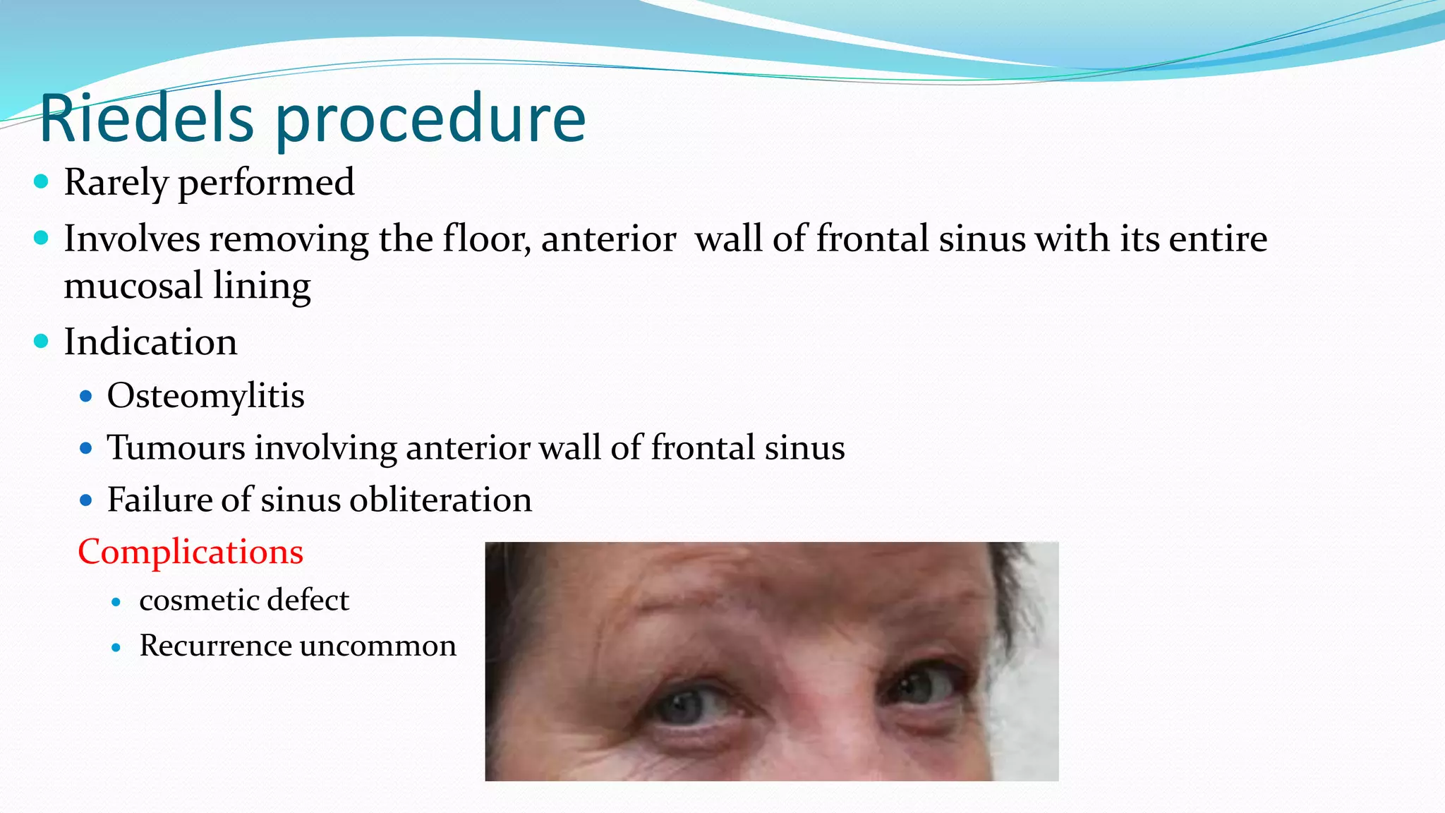 Frontal sinus surgical aproach | PPTX