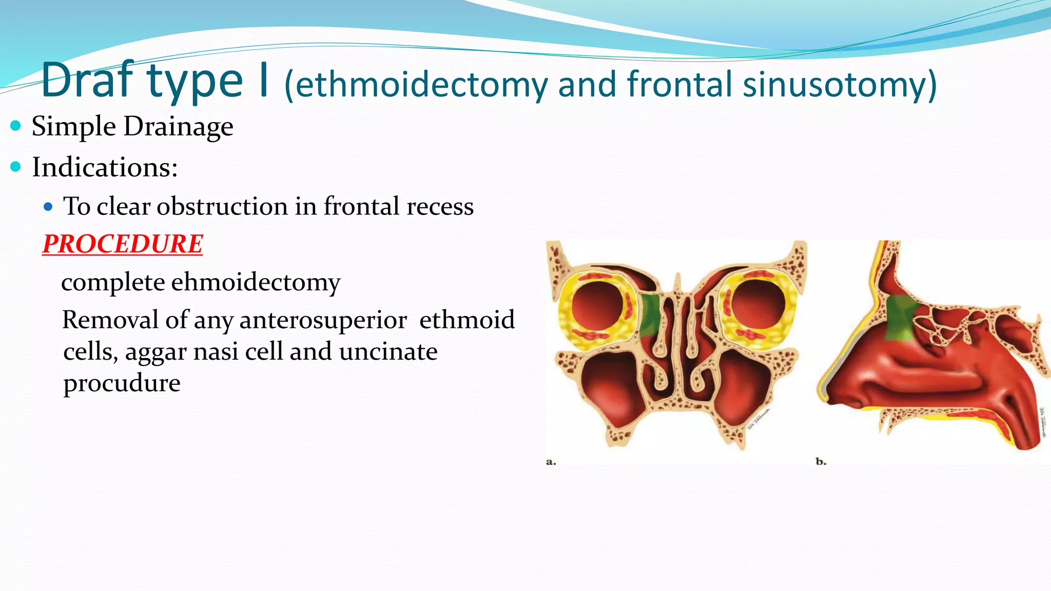 Frontal sinus surgical aproach | PPTX