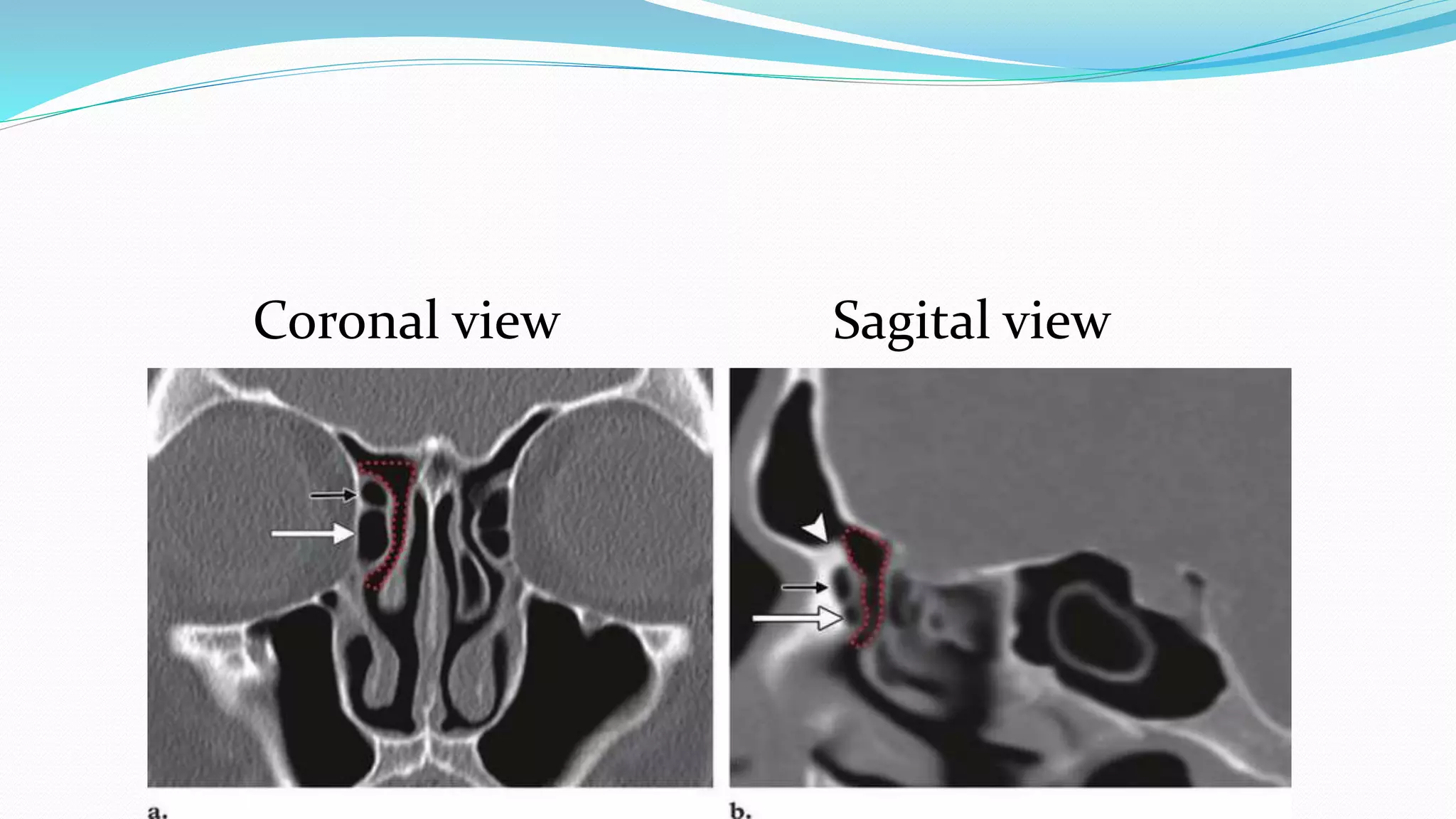 Frontal sinus surgical aproach | PPTX