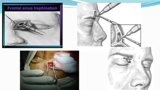 Frontal sinus surgical aproach | PPTX