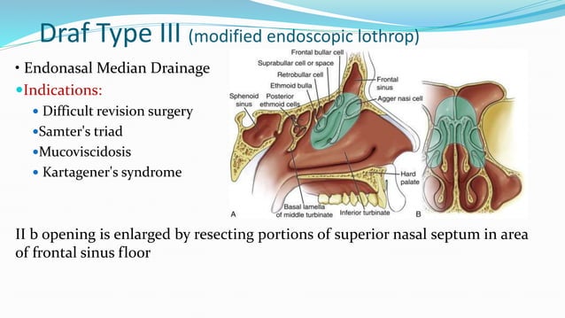 Frontal sinus surgical aproach | PPTX