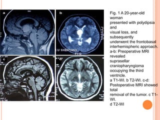 Frontobasal i̇nterhemispheric approach for large suprasellar ...