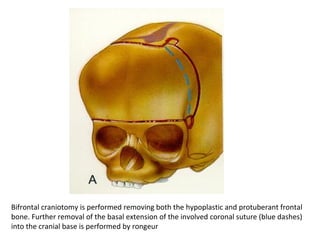 Frontoorbital advancement | PPT
