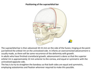 Frontoorbital advancement | PPT