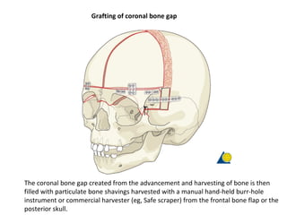 Frontoorbital advancement | PPT