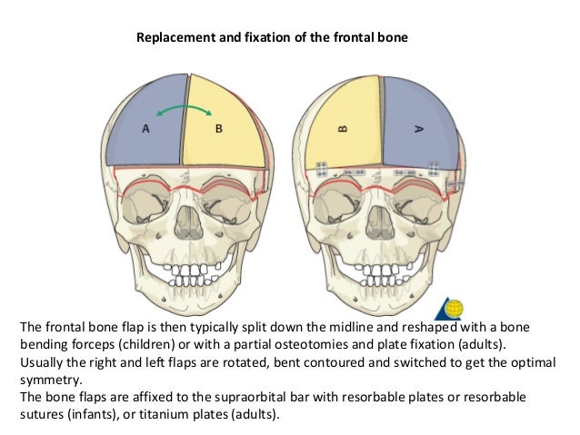 Frontoorbital advancement