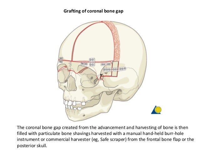 Frontoorbital advancement