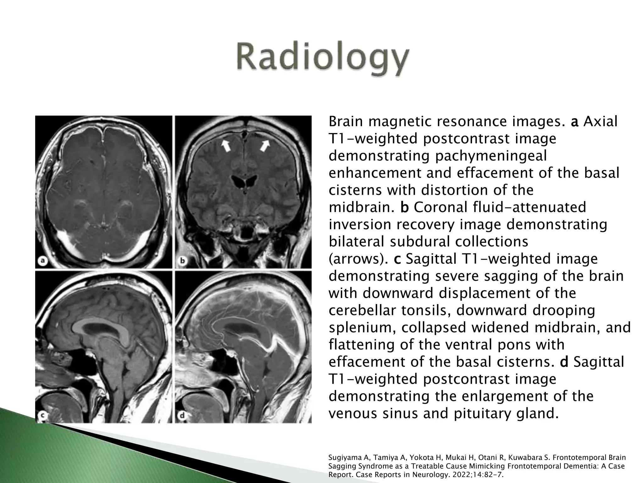 Frontotemporal Brain Sagging Syndrome.pptx
