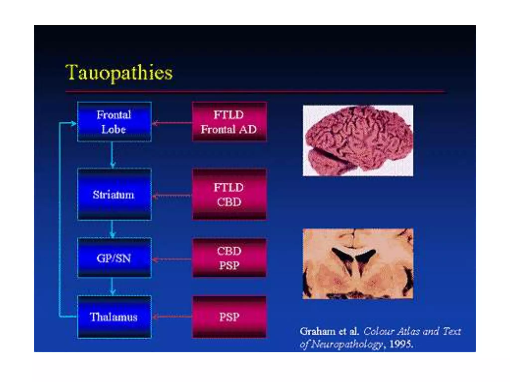 Frontotemporal dementia: Neural circuits, genetics and neuropathology ...