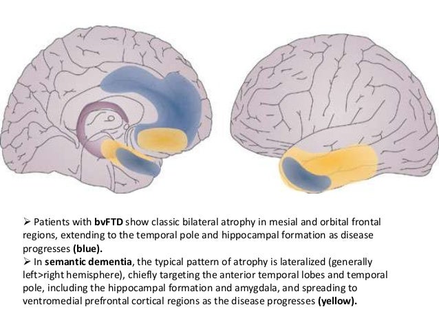 Frontotemporal dementia: Neural circuits, genetics and neuropathology